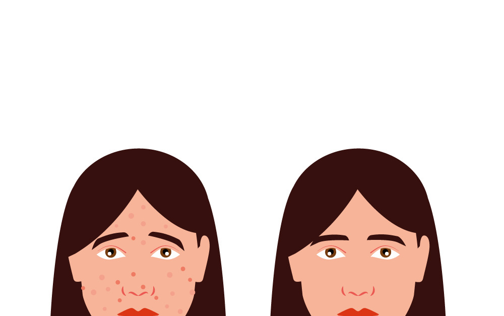 Face with acne and without acne #445657 - TemplateMonster