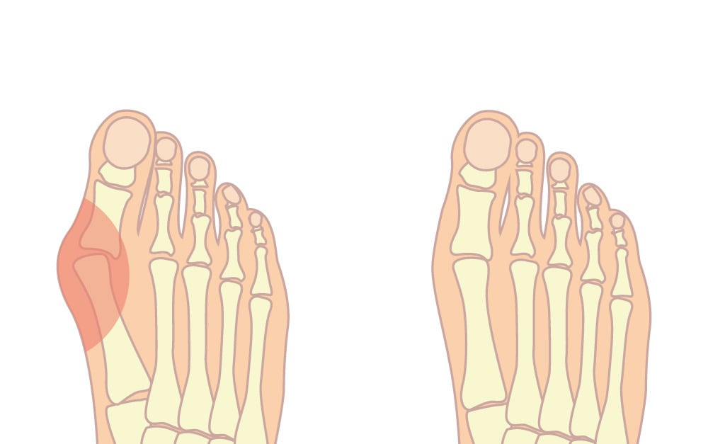 Normal Foot vs Hallux Valgus Anatomical Comparison